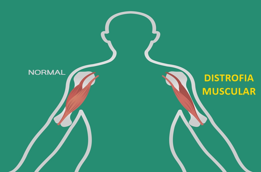 Decisão do STF limita o acesso de pacientes com distrofia muscular de ...